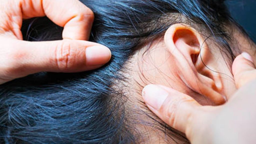 Infestación de piojos continúa pese al distanciamiento social